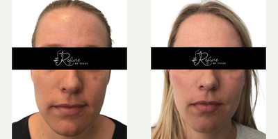 Cheek Fillers Before & After Pictures - RealSelf