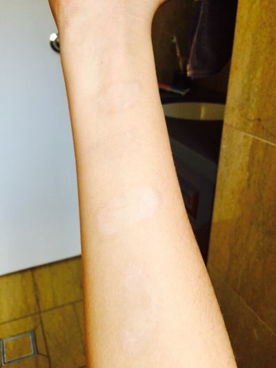 Is my salt and ice challenge scar permanent? I've tried everything to ...