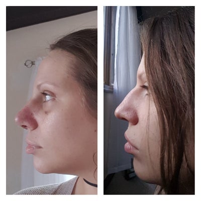 bad nose job pictures