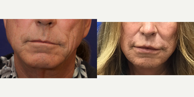 Genioplasty Before & After Pictures - RealSelf