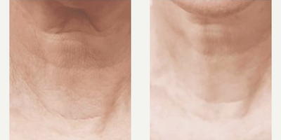 Sylfirm X Before & After Pictures - RealSelf