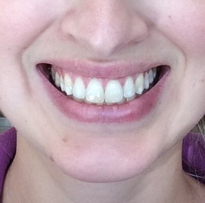 What can be done to correct my Buccal Corridor? I'm 27 YO Female ...