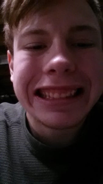 I have an overbite and a weak chin. As well as puffy cheeks. How do I ...