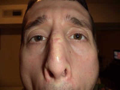 What can I do to make my nostrils more even? (photo) Doctor Answers, Tips
