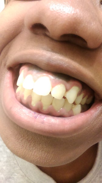 I only have one front tooth, so the top row of my teeth are overlapping ...