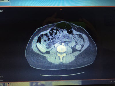 Based on these ct photos, do I have a hernia, diastasis recti or both ...