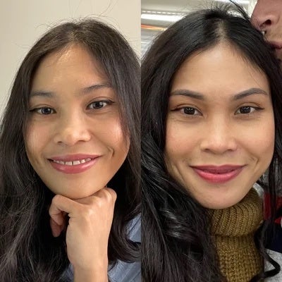 dimpleplasty gone wrong