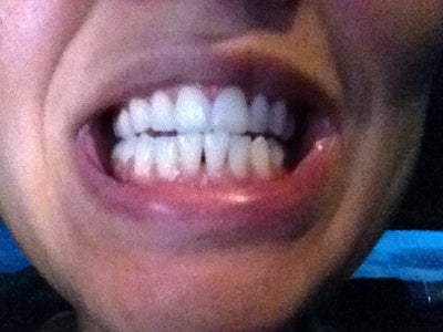 Bonding or Veneers for Black Triangle Lower Front Teeth? (photo) Doctor ...