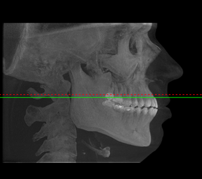 Double chin: Surgery for low hyoid? (photos) Doctor Answers, Tips