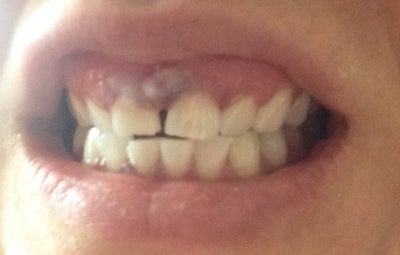 Zoom whitening chemical burns on my gums. How long until it heals ...