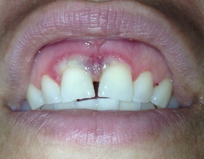 Zoom whitening chemical burns on my gums. How long until it heals ...