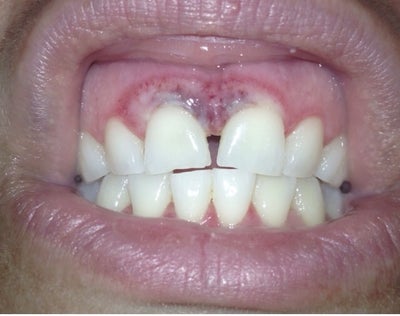 Zoom whitening chemical burns on my gums. How long until it heals ...