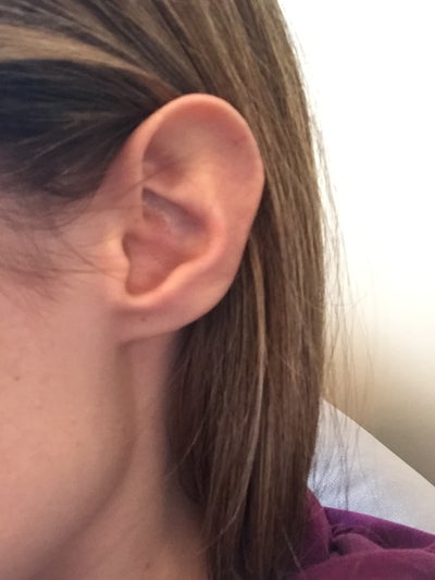 Why do my ears lack a fold/helix at the top? (photos) Doctor Answers, Tips