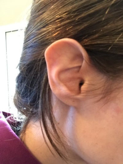 Why do my ears lack a fold/helix at the top? (photos) Doctor Answers, Tips