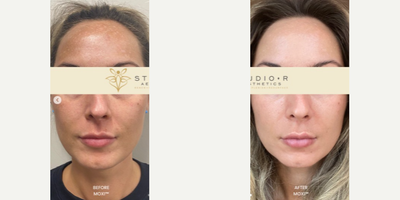 Moxi Before & After Pictures - RealSelf