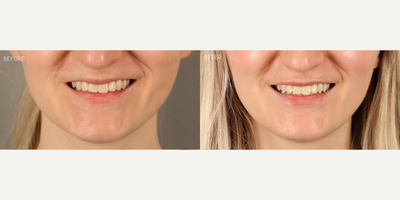 Restylane Kysse Before & After Pictures - RealSelf