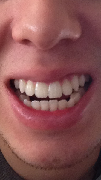 Front Tooth is Uneven? (photo) Dentist Answers, Tips