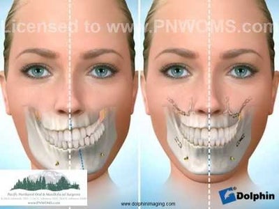 How does one develop a misaligned jaw? Paranoid TMJ sufferer (Photo ...