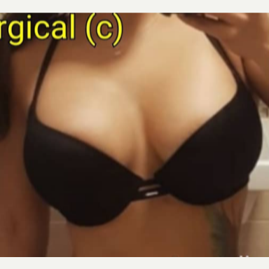 large breast implants realself