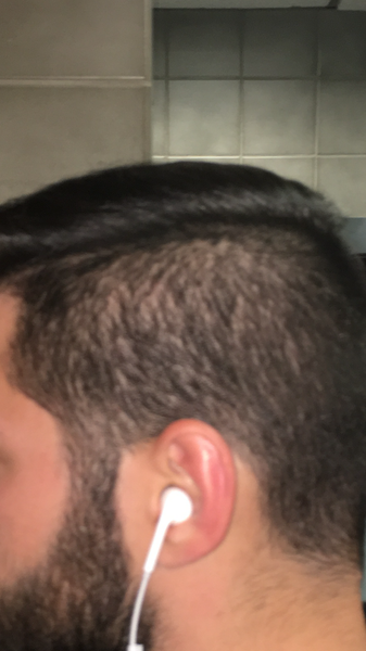 Do I have Dupa (Diffuse Unpatterned Alopecia)? (photos) Doctor Answers ...
