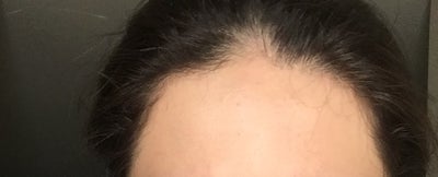 Any suggestions for hairline gap fix? (photos) Doctor Answers, Tips