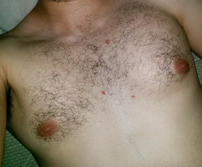 pectoral implants gone wrong