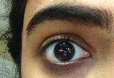 Why does one eye slant down and have weak bone projection? (Photo ...