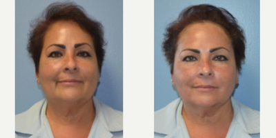 PRP Injections Before & After Pictures - RealSelf