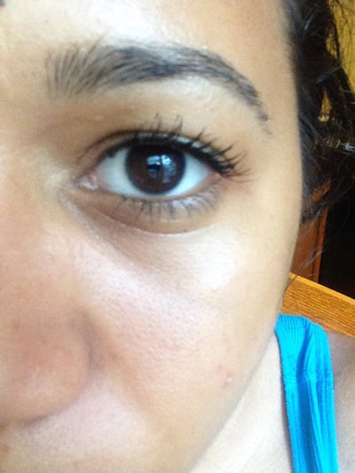 What treatment would you recommend for deep lines under eyes ? (photos ...