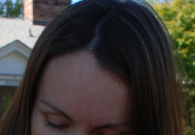 Which procedure is best for me to correct a widow's peak and uneven ...