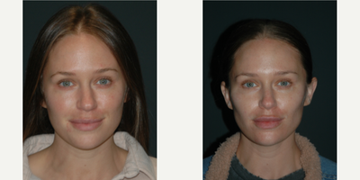 Cheek Lift Before & After Pictures - RealSelf