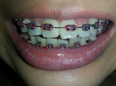 4 years with braces and teeth are still crooked. What do you think ...