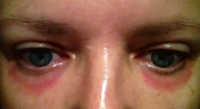 Red Marks Under Eyes After CO2 Laser and Healing, Is This Normal ...