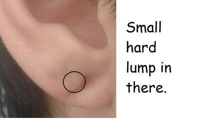 Ear lobe crease and lump from piercing (photos) Doctor Answers, Tips