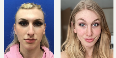 Cheek Augmentation Before & After Pictures - RealSelf