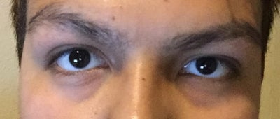 I have one eye that opens bigger and is slanted more than the other ...