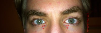 Are asymmetric eyes normal? (photo) Doctor Answers, Tips