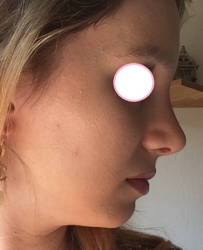 Do I have high or low bridge nose? (Photo) Doctor Answers, Tips