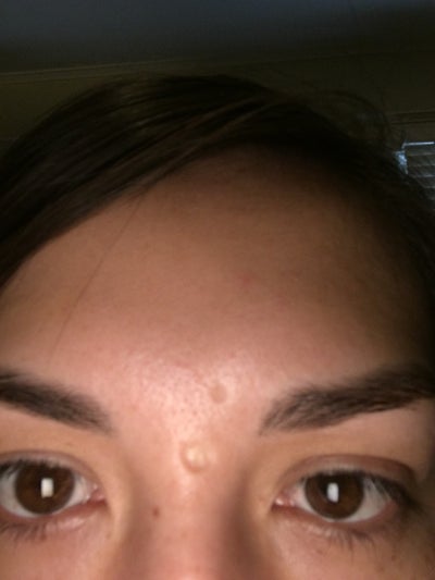 How do I get rid of this chicken pox scar? (photos) Doctor Answers, Tips