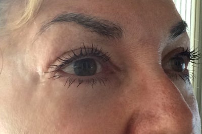 What's the best treatment for dents on the side of my eyes after lower ...