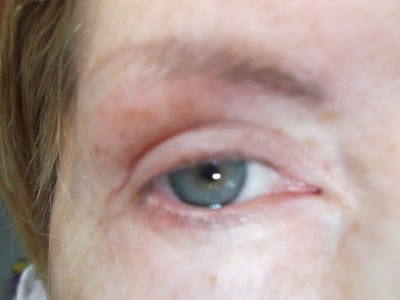 I have an excessive skin above scar line after bilateral upper eyelid ...