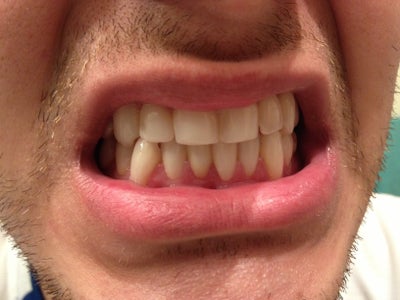 Can Veneers Be Taken off to Do an Ortho and Have Braces Put-on on my ...