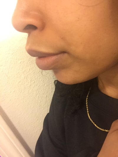 How to fix a long philtrum and protruding lips/mouth? (photos) Doctor ...