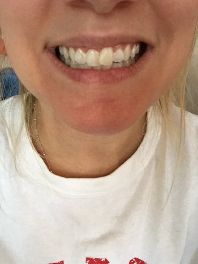 Are veneers possible with my overlapping front teeth? (photos) Doctor ...