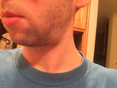 Is there a way to get rid of the bumps under my jawline so I have a ...