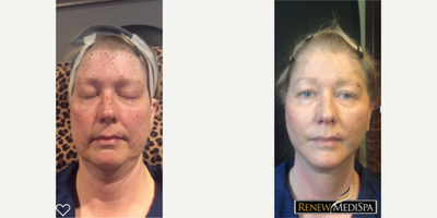 Thread Lift Before & After Pictures - RealSelf
