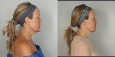 MyEllevate Before & After Pictures - RealSelf