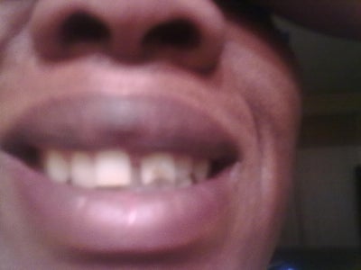 Why Did my Bonded Front Tooth Fall out After Having It Done Ten Days ...