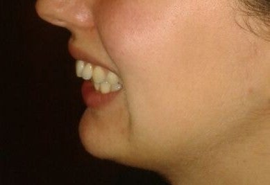 Can my 10mm Overbite Be Improved by Interproximal Reduction or Would ...