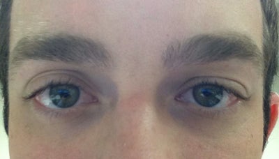 Do I have extra skin above one eye? Doctor Answers, Tips